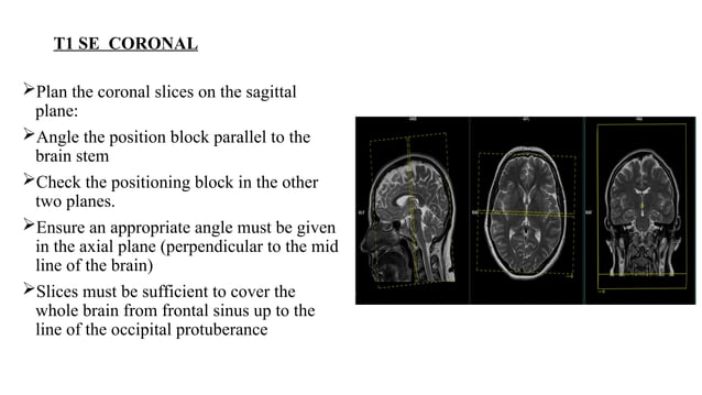 10.MRI Brain Epilepsy (Seizure) Protocol-2.pptx