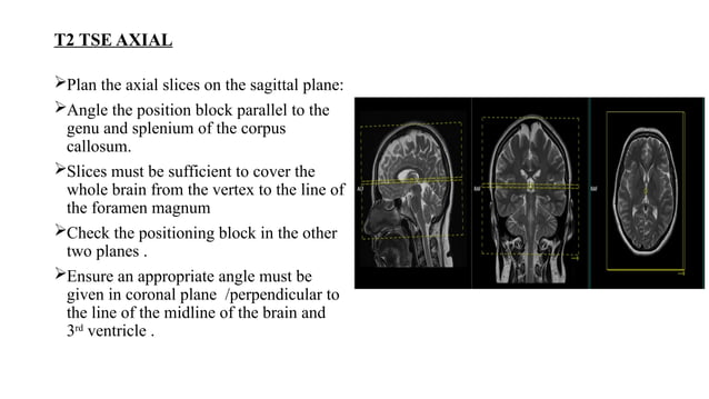 10.MRI Brain Epilepsy (Seizure) Protocol-2.pptx