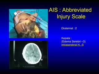 10. Trauma skoring.ppt ................. | PPT