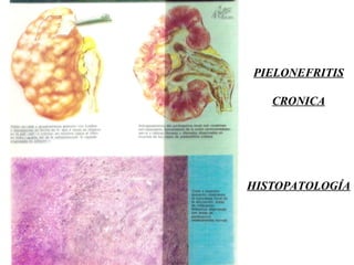 10.- INFECCION URINARIA gaby nefrol. ppt | PPT