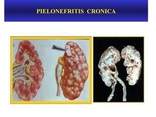10.- INFECCION URINARIA gaby nefrol. ppt | PPT