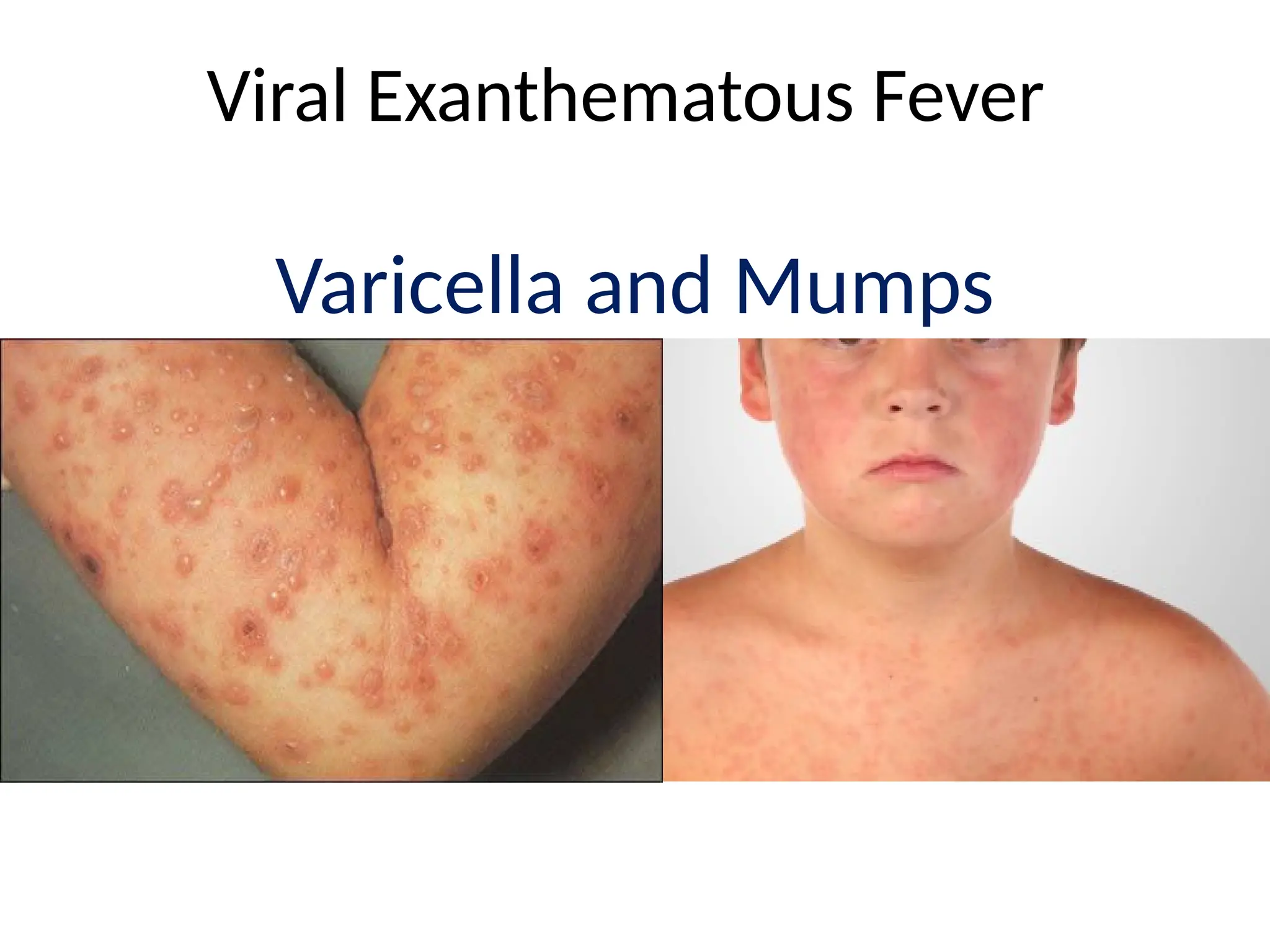 10. Viral Exanthematous Fever II (Varicella and Mumps).pptx