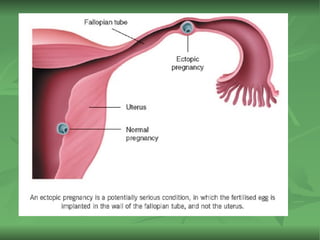 10. ectopic pregnancy.pptx common symptoms and management | PPTX