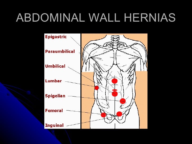 Ventral Hernia Icd 10 Ventral Hernia Icd 10