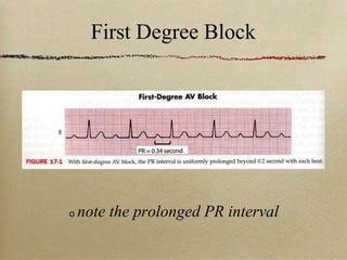 10-AV-blocks.ppt