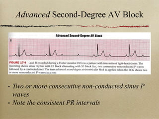 10-AV-blocks.ppt | Heart and Cardiovascular Diseases | Diseases and ...