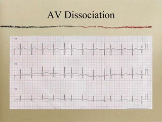10-AV-blocks.ppt | Heart and Cardiovascular Diseases | Diseases and ...