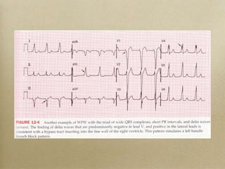 10-AV-blocks.ppt | Heart and Cardiovascular Diseases | Diseases and ...