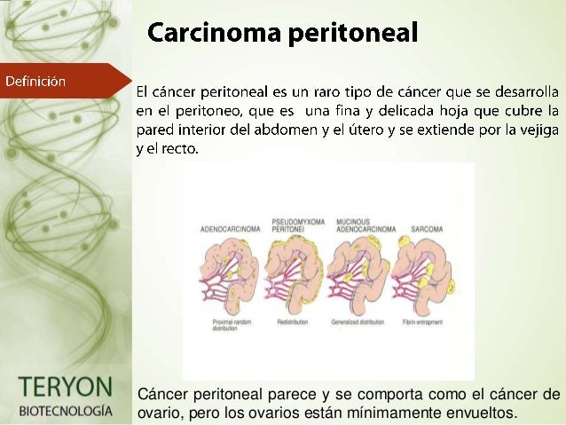 Cáncer Primario De Peritoneo. Generalidades Quirúrgicas Para Una – FZMNG