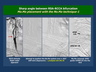 Montorsi P - AIMRADIAL 2015 - Carotid artery stenting | PPT