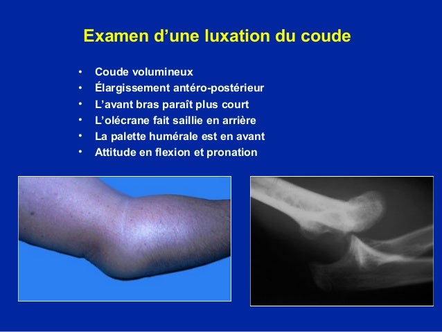 Luxations du coude