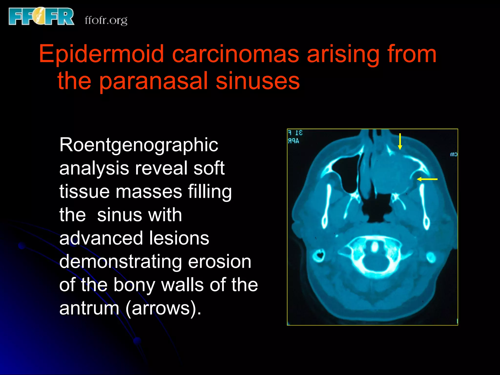 10. etiology of palatal and paranasal sinus defects | PPT | Ear, Nose ...
