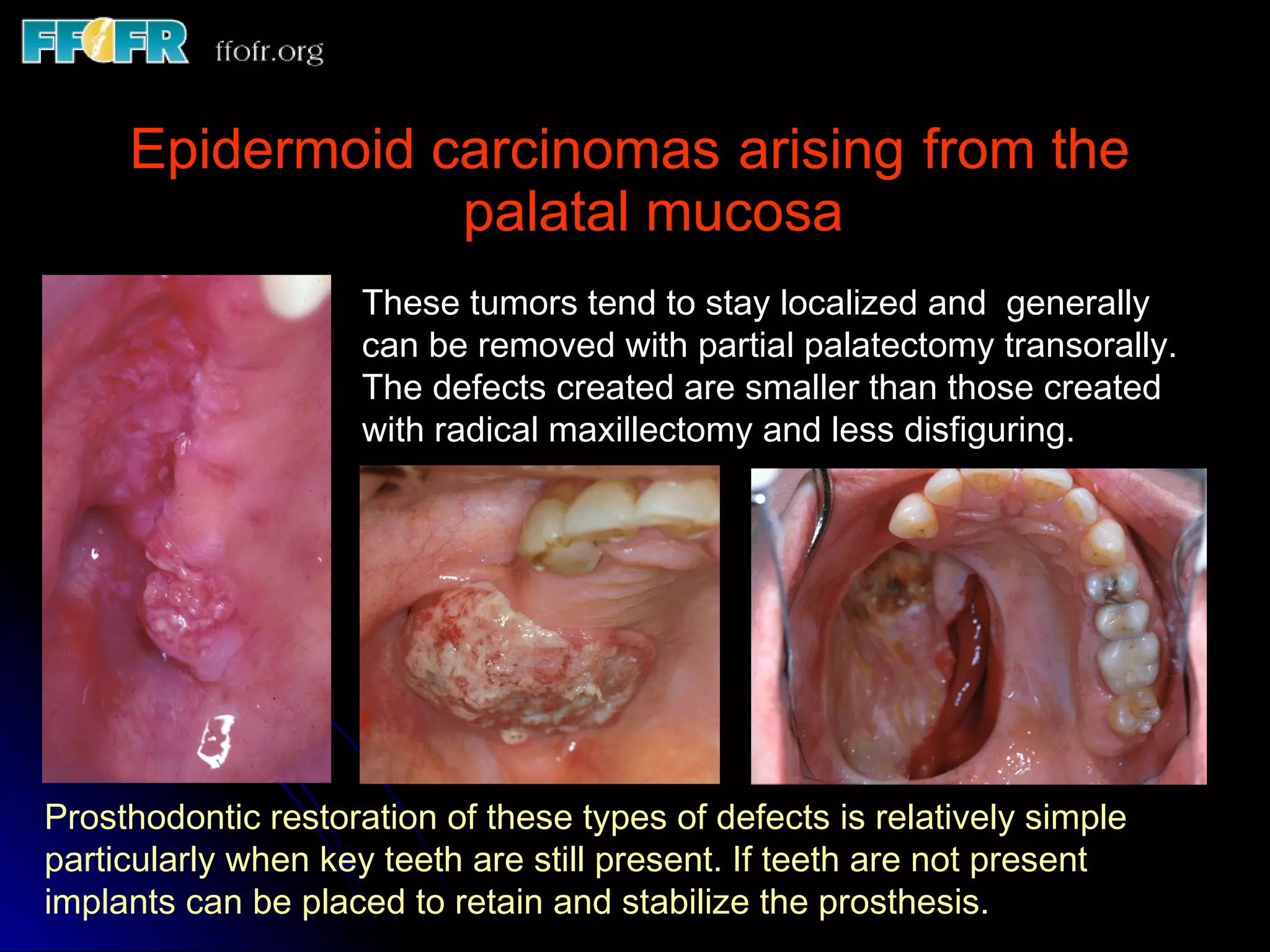 10. etiology of palatal and paranasal sinus defects | PPT | Ear, Nose ...