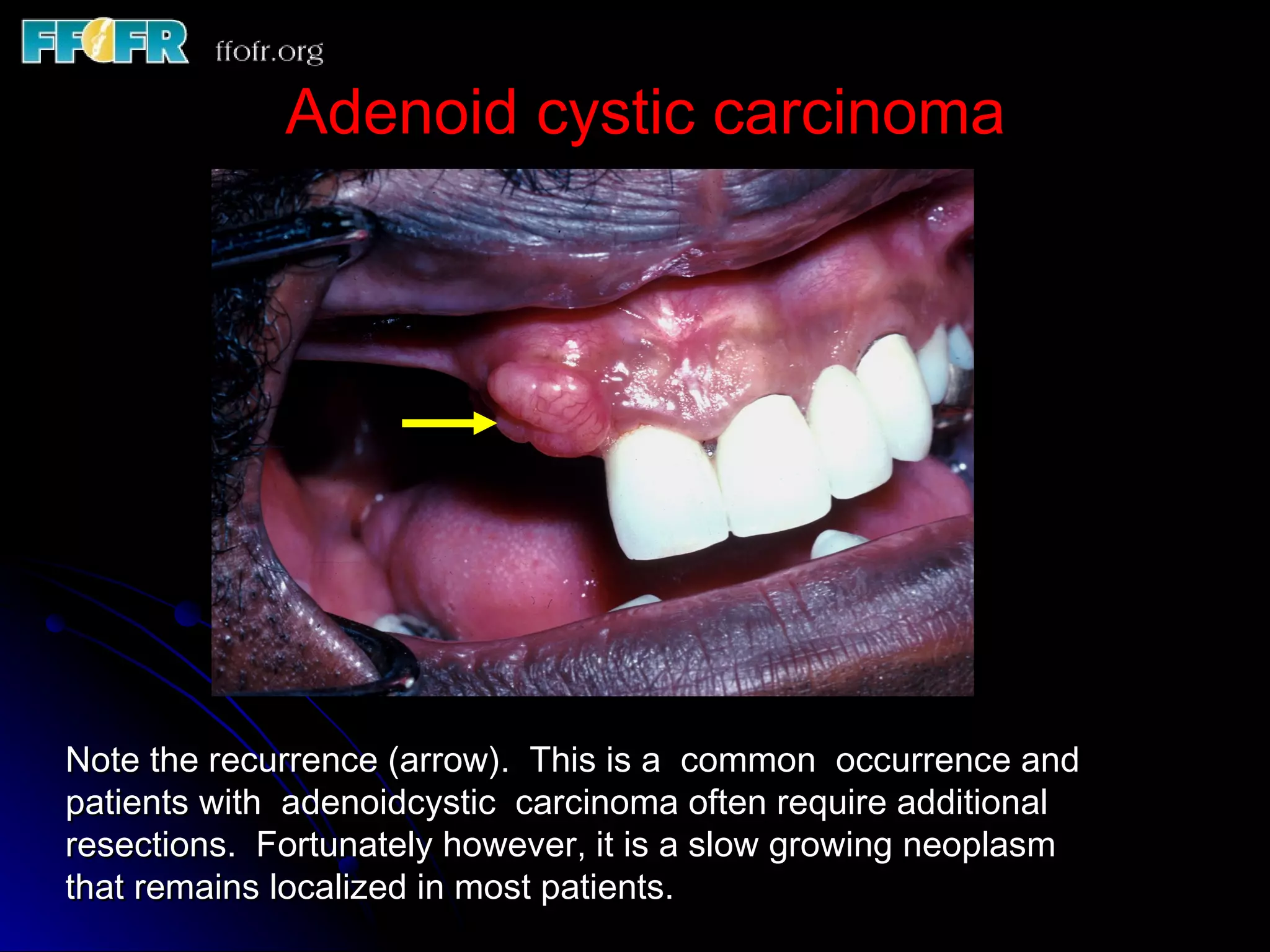 10. etiology of palatal and paranasal sinus defects | PPT | Ear, Nose ...