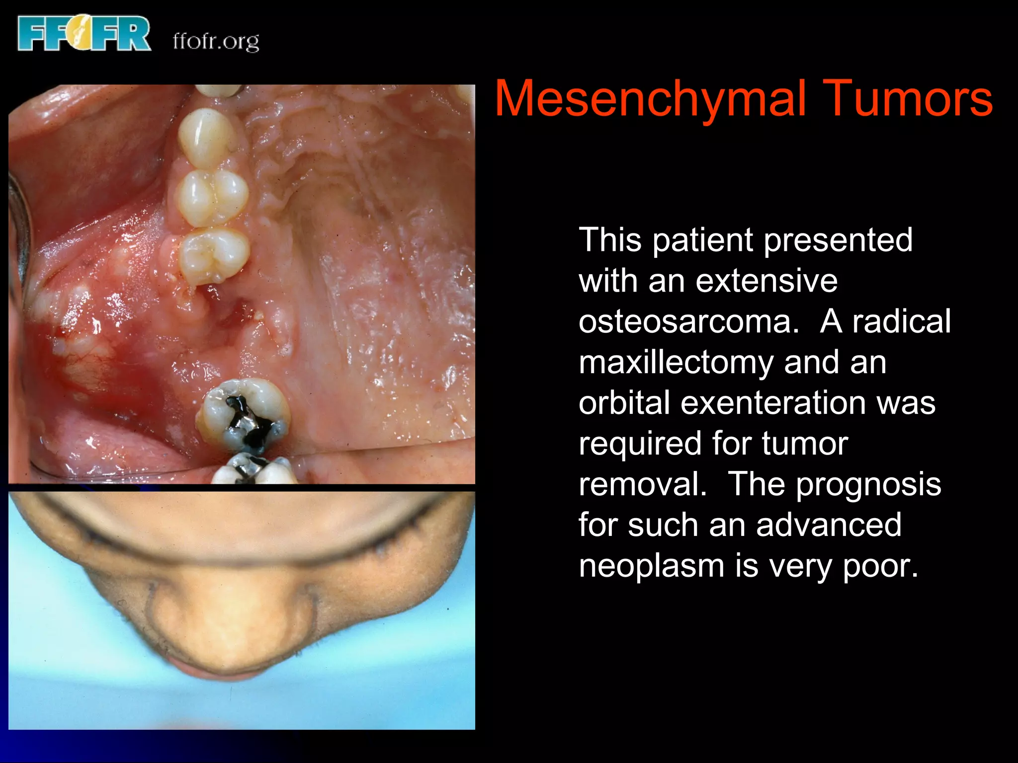 10. etiology of palatal and paranasal sinus defects | PPT | Ear, Nose ...