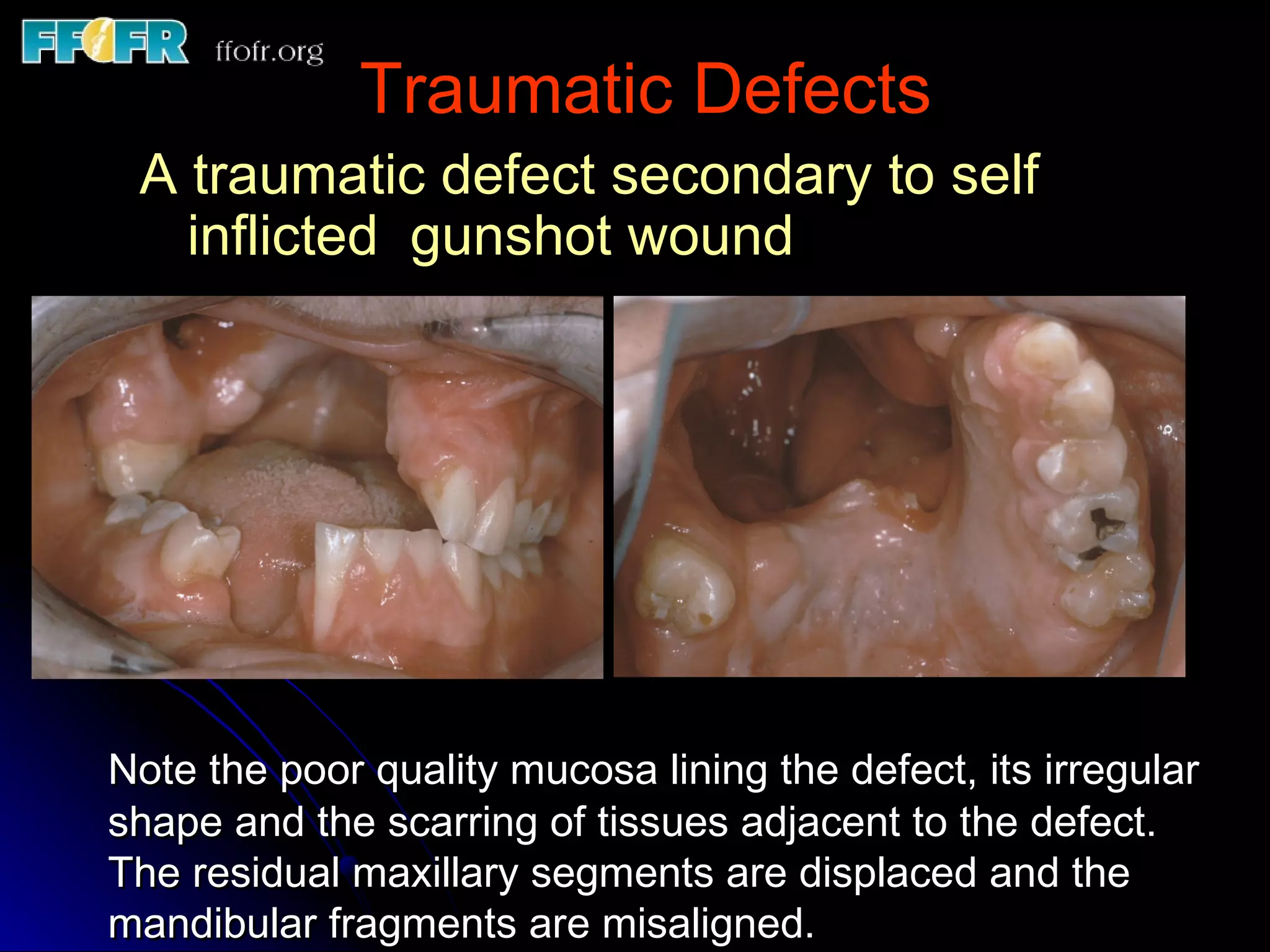 10. etiology of palatal and paranasal sinus defects | PPT | Ear, Nose ...