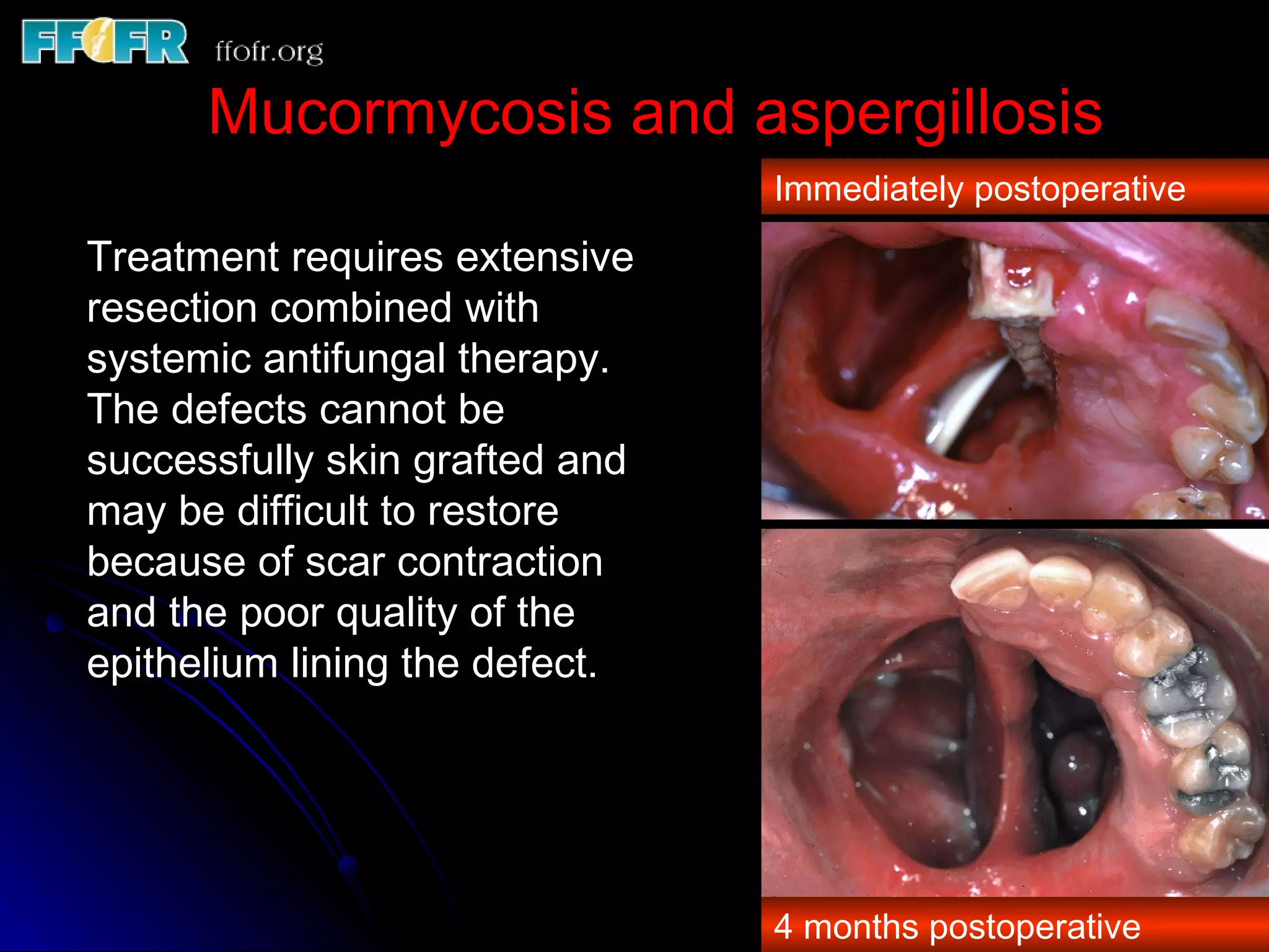 10. etiology of palatal and paranasal sinus defects | PPT | Ear, Nose ...