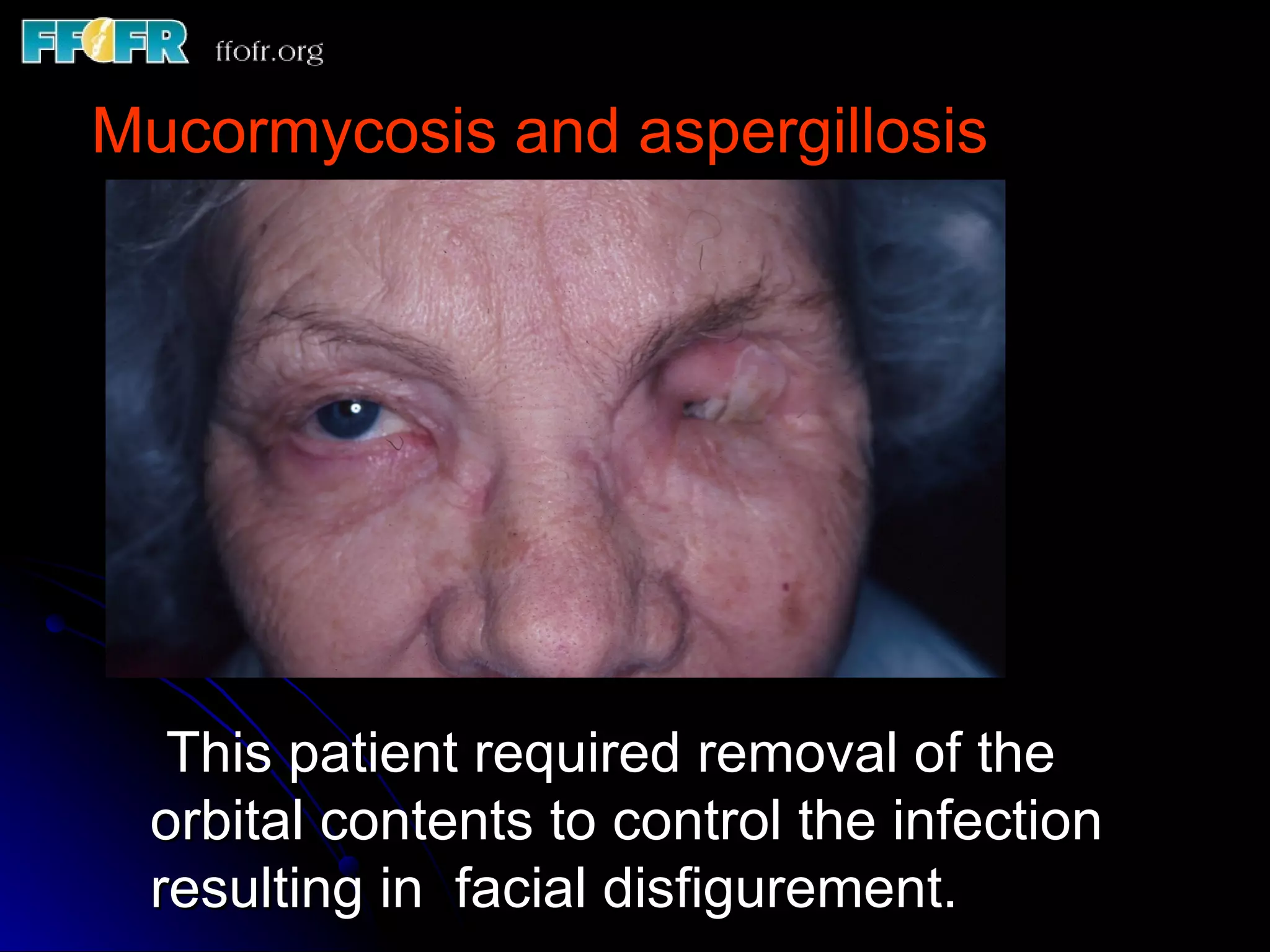 10. etiology of palatal and paranasal sinus defects | PPT | Ear, Nose ...