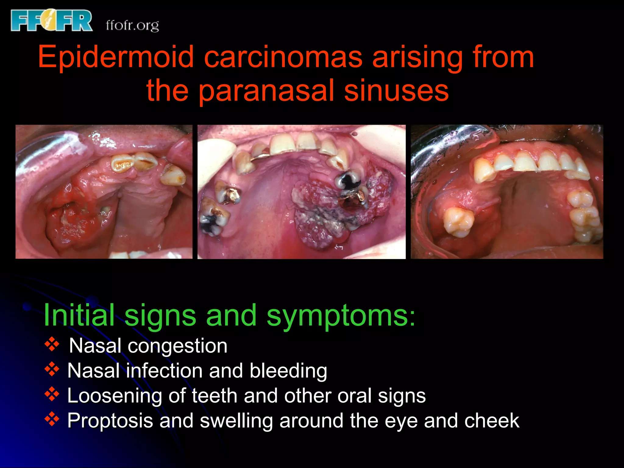 10. etiology of palatal and paranasal sinus defects | PPT | Ear, Nose ...