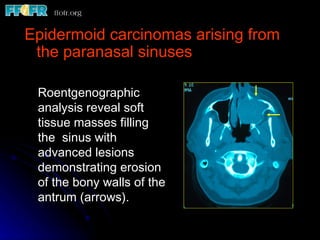 10. etiology of palatal and paranasal sinus defects | PPT | Ear, Nose ...