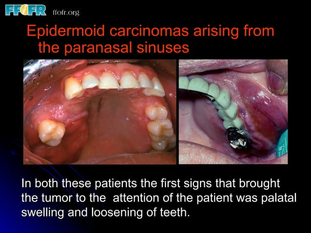 10. etiology of palatal and paranasal sinus defects | PPT | Ear, Nose ...