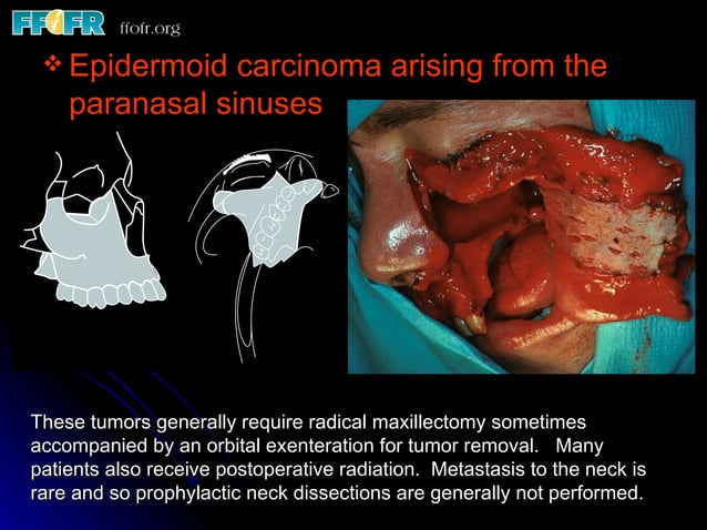 10. etiology of palatal and paranasal sinus defects | PPT | Ear, Nose ...