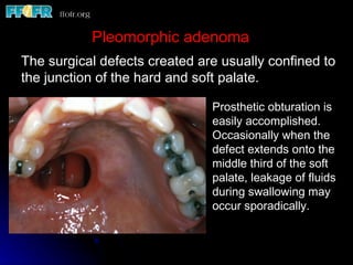 10. etiology of palatal and paranasal sinus defects | PPT | Ear, Nose ...