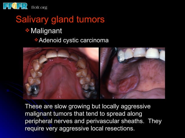 10. etiology of palatal and paranasal sinus defects | PPT | Ear, Nose ...
