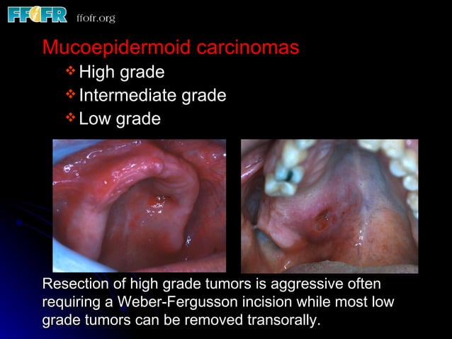 10. etiology of palatal and paranasal sinus defects | PPT | Ear, Nose ...