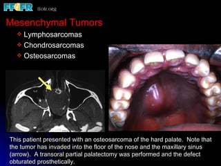 10. etiology of palatal and paranasal sinus defects | PPT