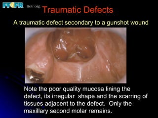 10. etiology of palatal and paranasal sinus defects | PPT | Ear, Nose ...