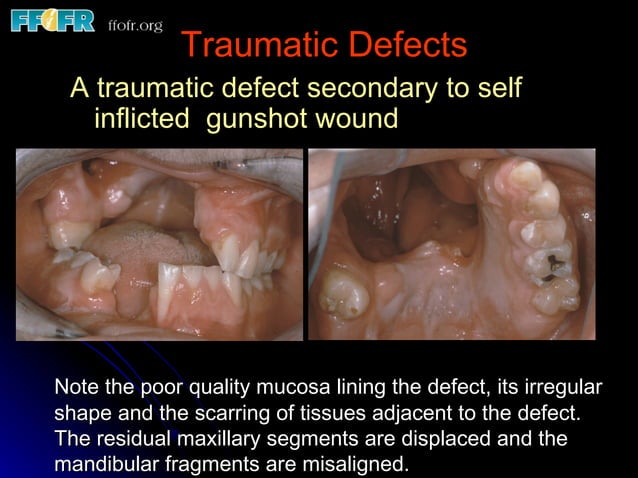 10. etiology of palatal and paranasal sinus defects | PPT | Ear, Nose ...