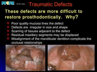10. etiology of palatal and paranasal sinus defects | PPT | Ear, Nose ...