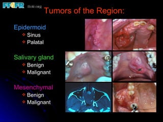 10. etiology of palatal and paranasal sinus defects | PPT