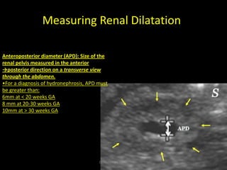 10-Fetal urinary tract Dr Ahmed Esawy | PDF