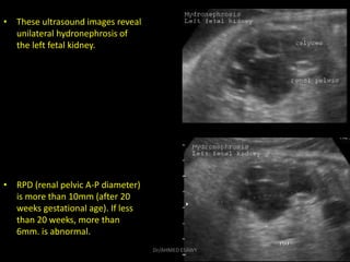 10-Fetal urinary tract Dr Ahmed Esawy | PDF