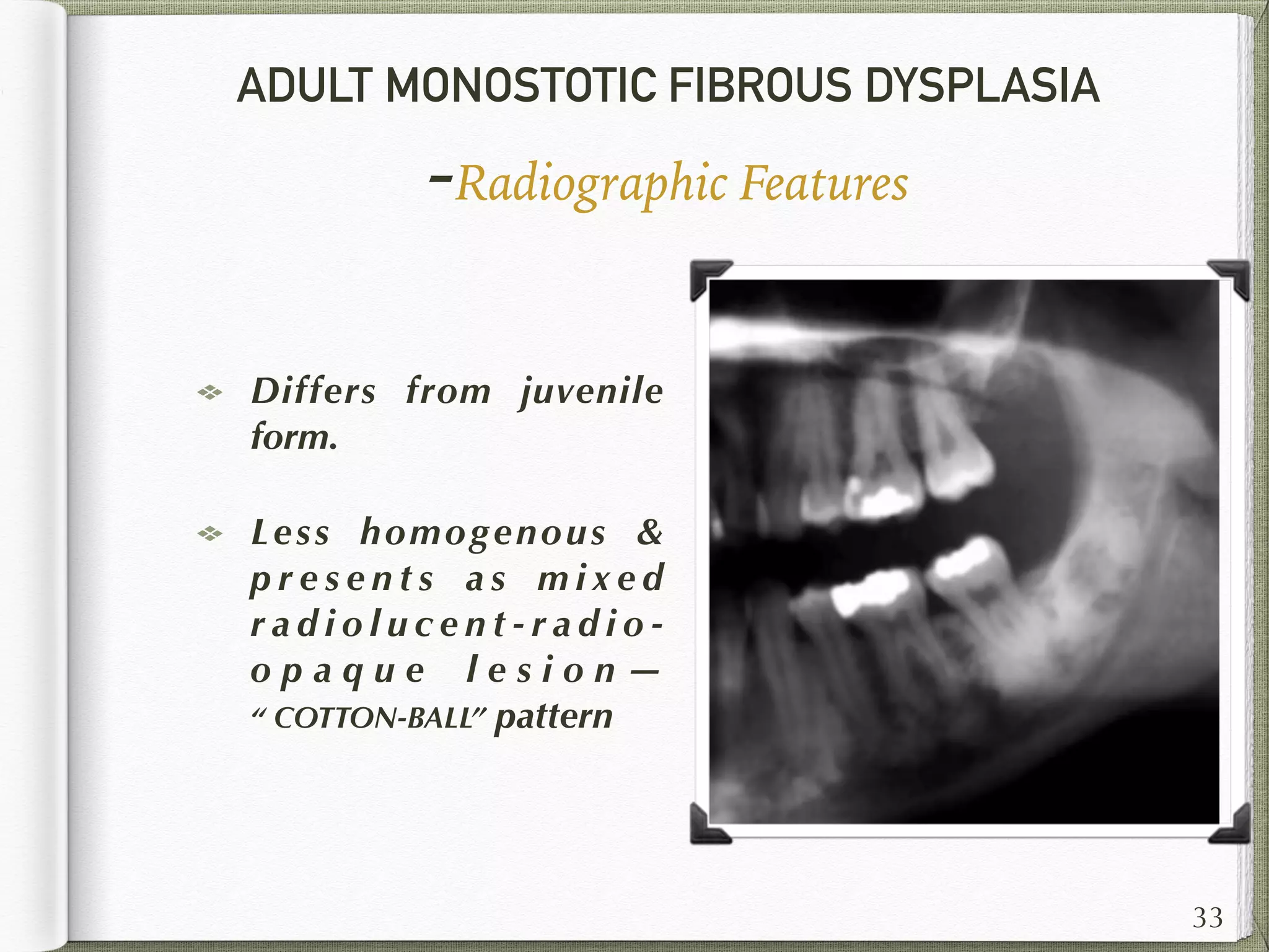 Fibro-osseous Lesions | PDF