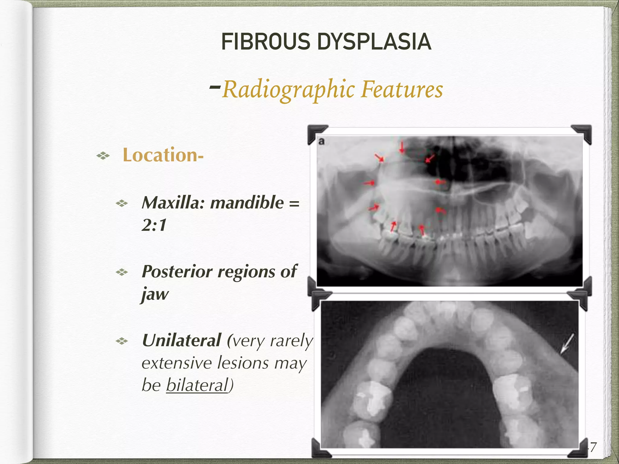 Fibro-osseous Lesions | PDF