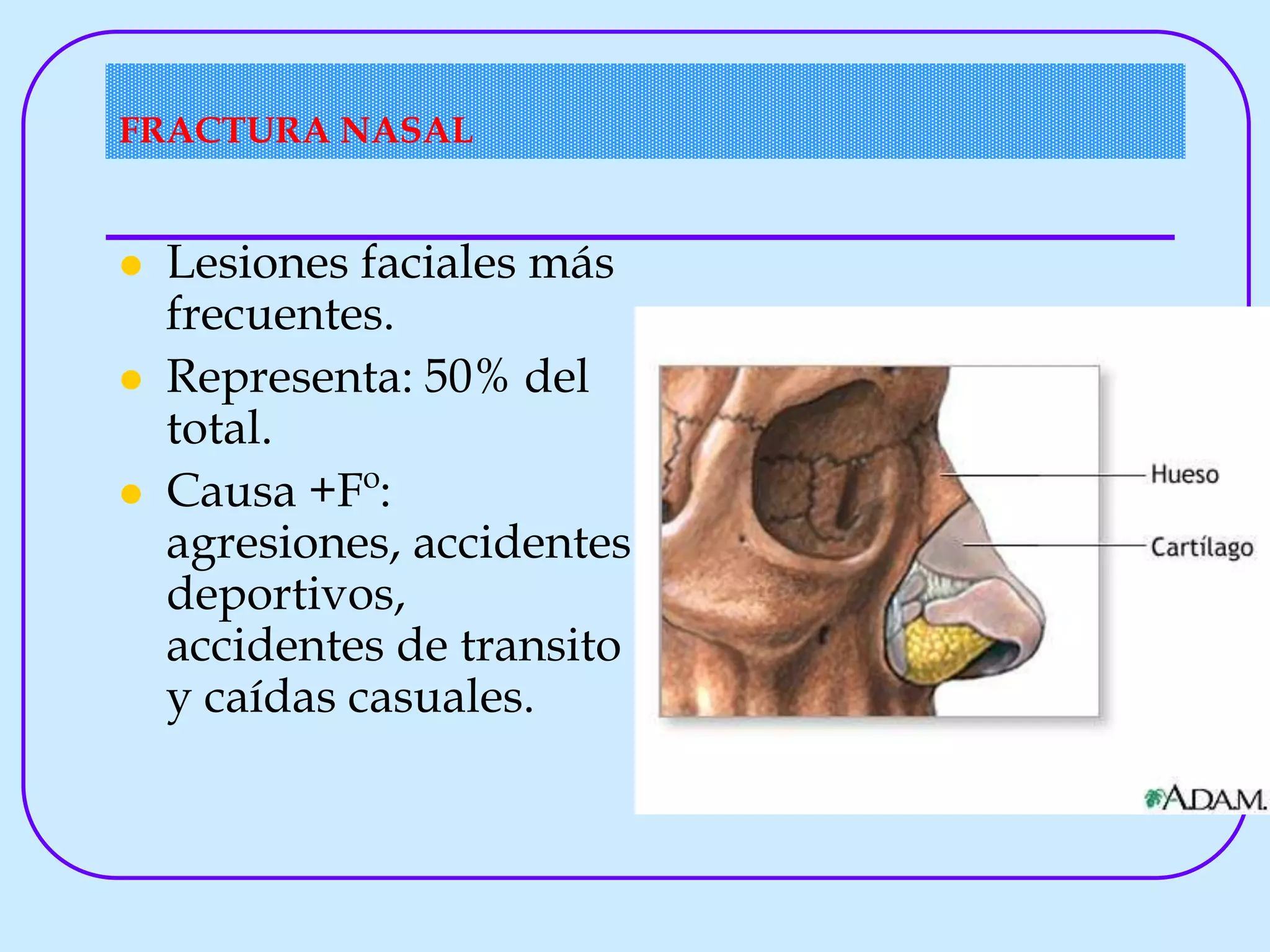 10. fractura nasal | PPTX