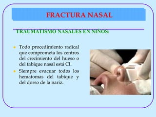 10. fractura nasal | PPTX