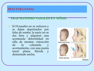 10. fractura nasal | PPTX