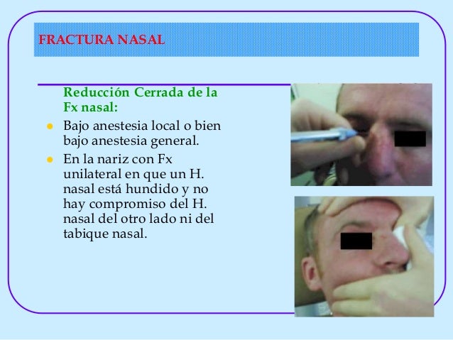 10. fractura nasal