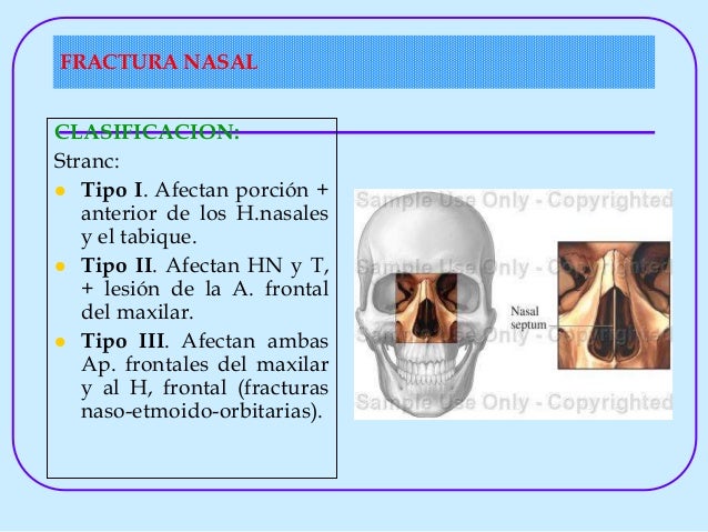 10. fractura nasal