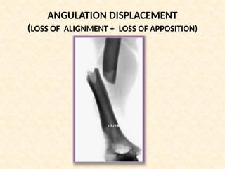 10-FRACTURES in all human body and management.pptx