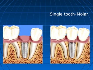 history,types of Implants 2013 | PPT
