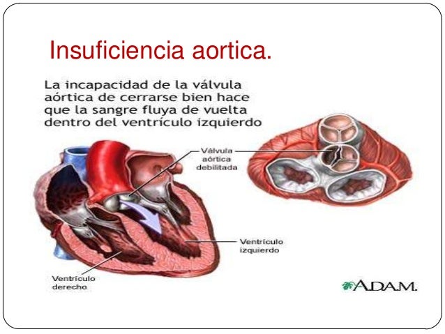 10 insuficiencia aortica.