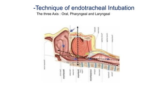 endotracheal intubation-Anesthesia | PDF