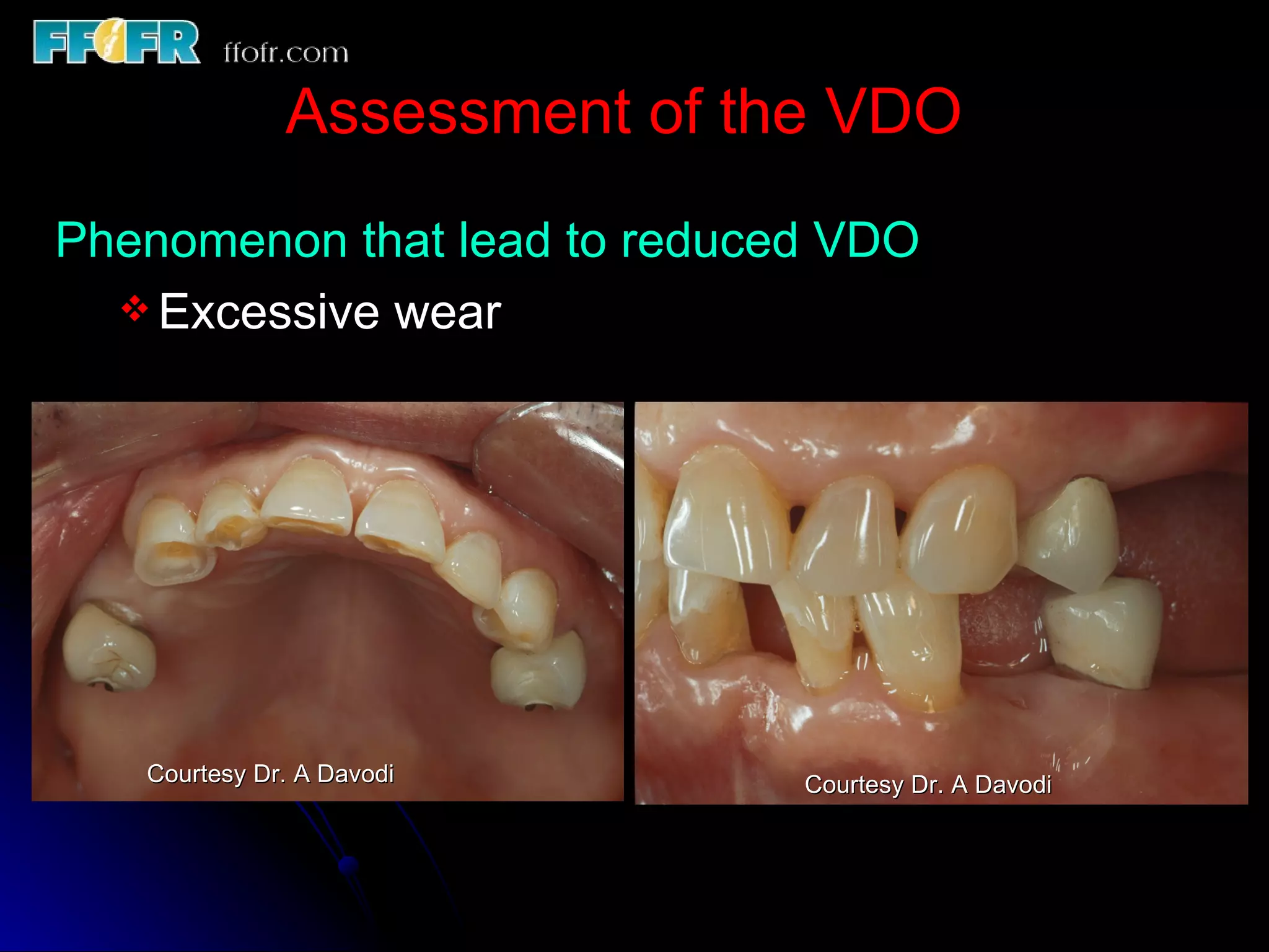 10.maxillo mandibular records | PPT