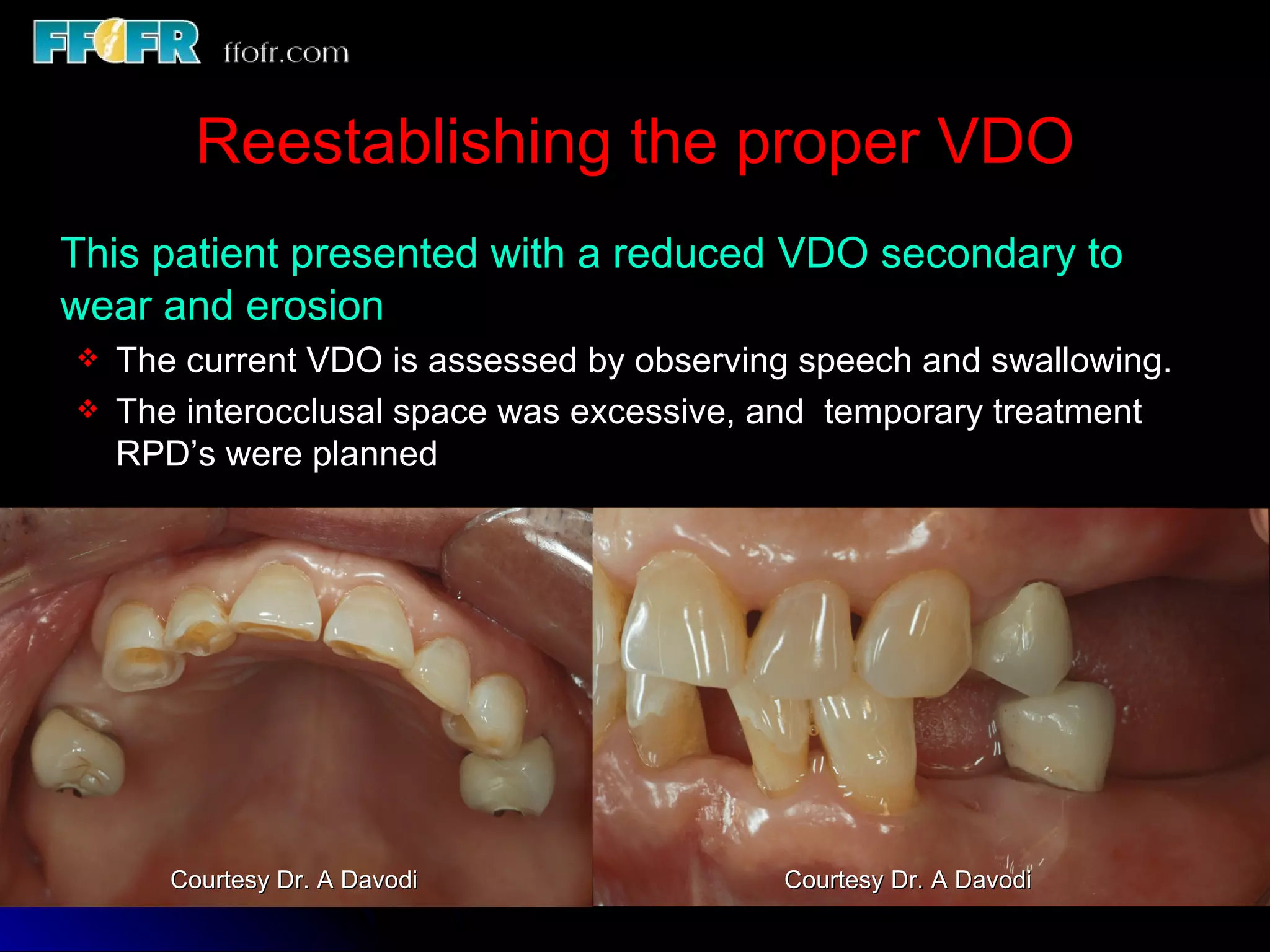 10.maxillo mandibular records | PPT