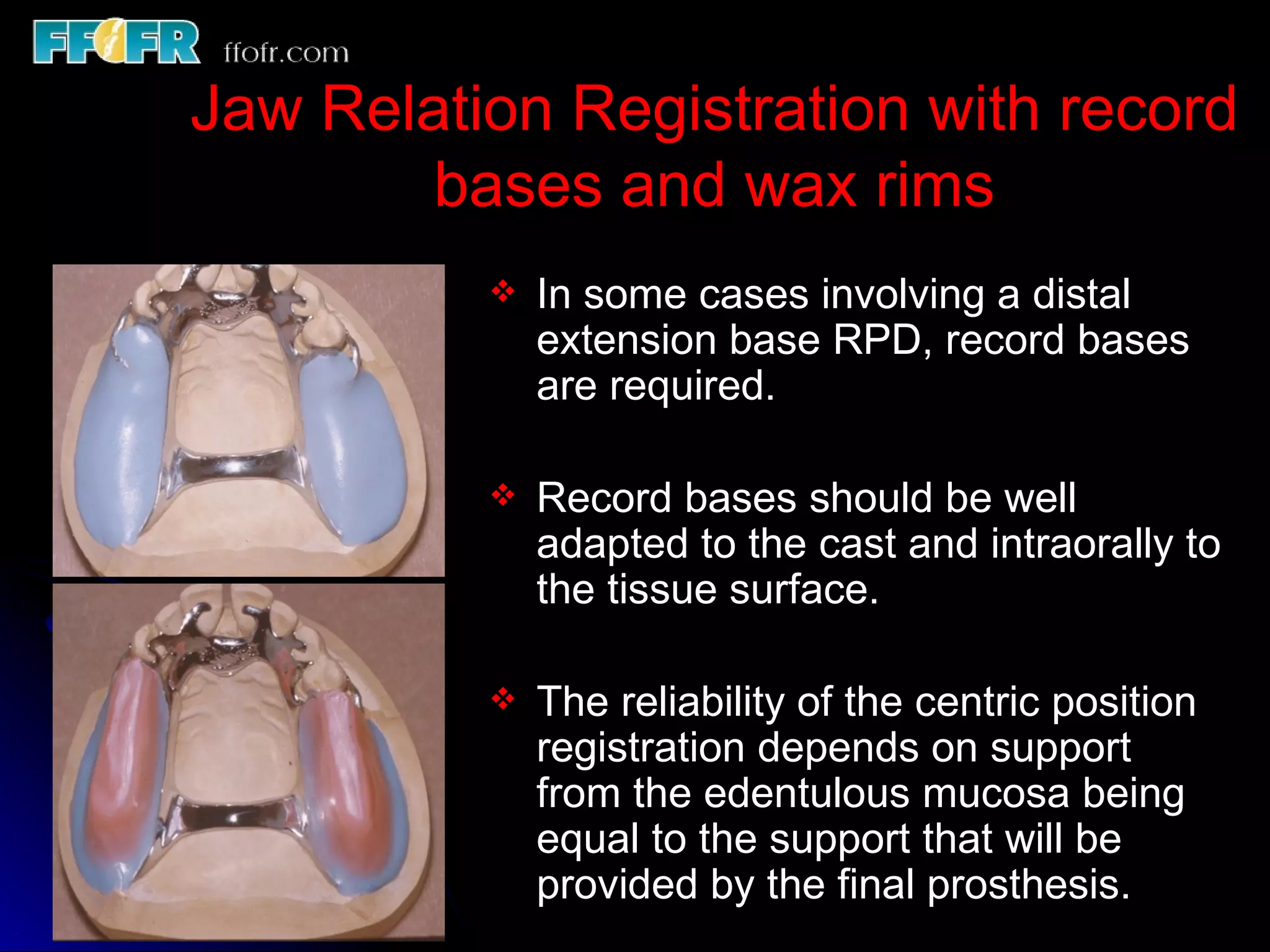 10.maxillo mandibular records | PPT